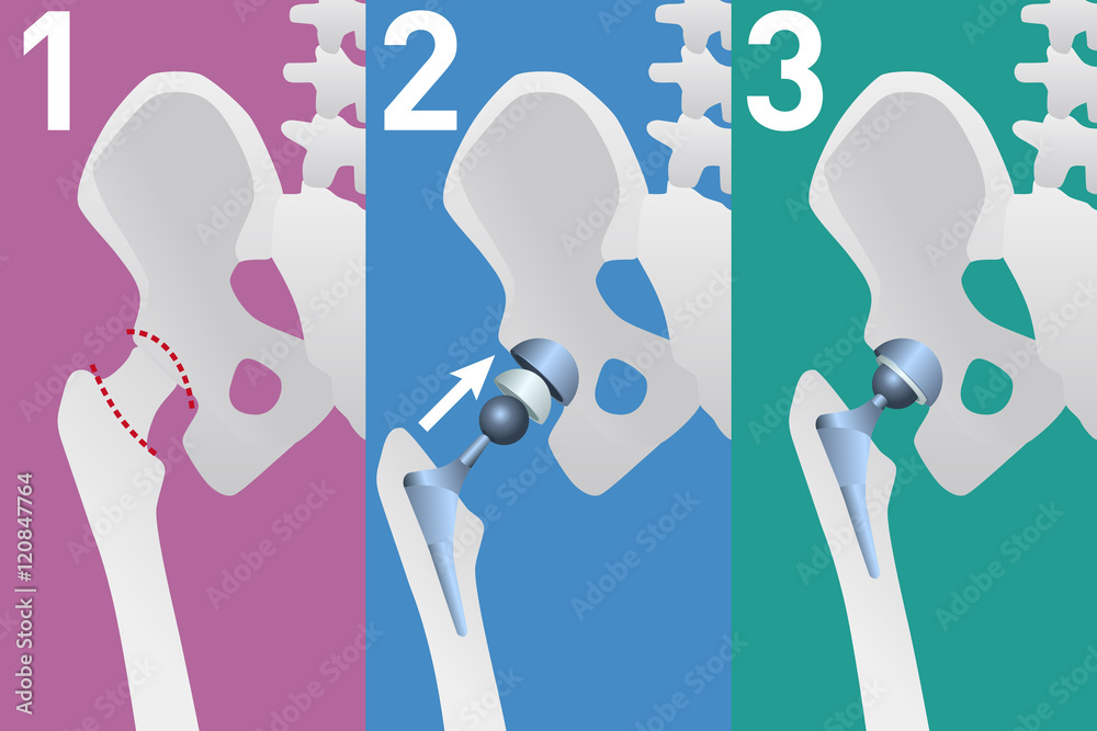 hip replacement arthroplasty diagram, vector illustration Stock Vector ...