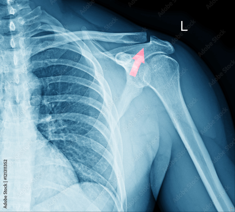 X-ray film of shoulder fracture Stock Photo | Adobe Stock