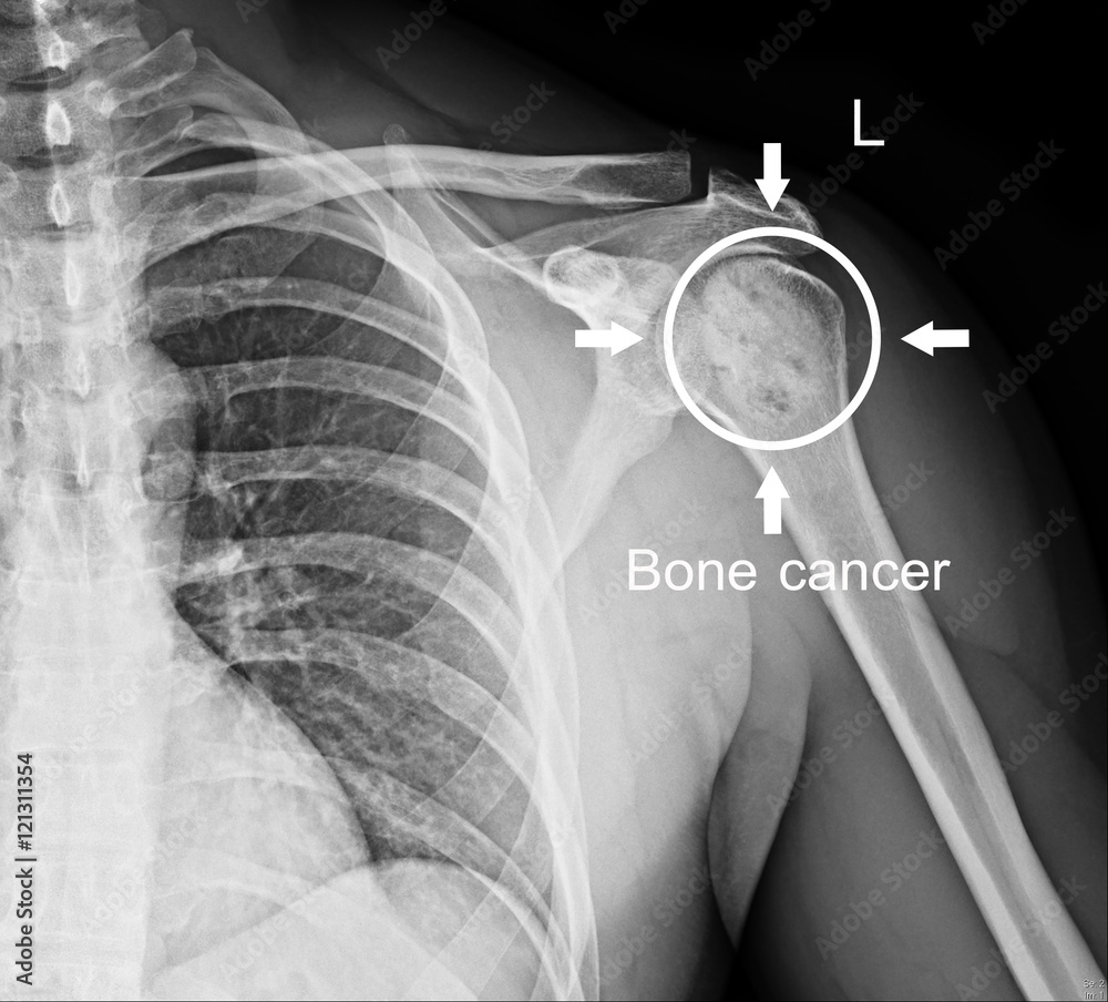 X-ray film of shoulder fracture Stock Photo | Adobe Stock