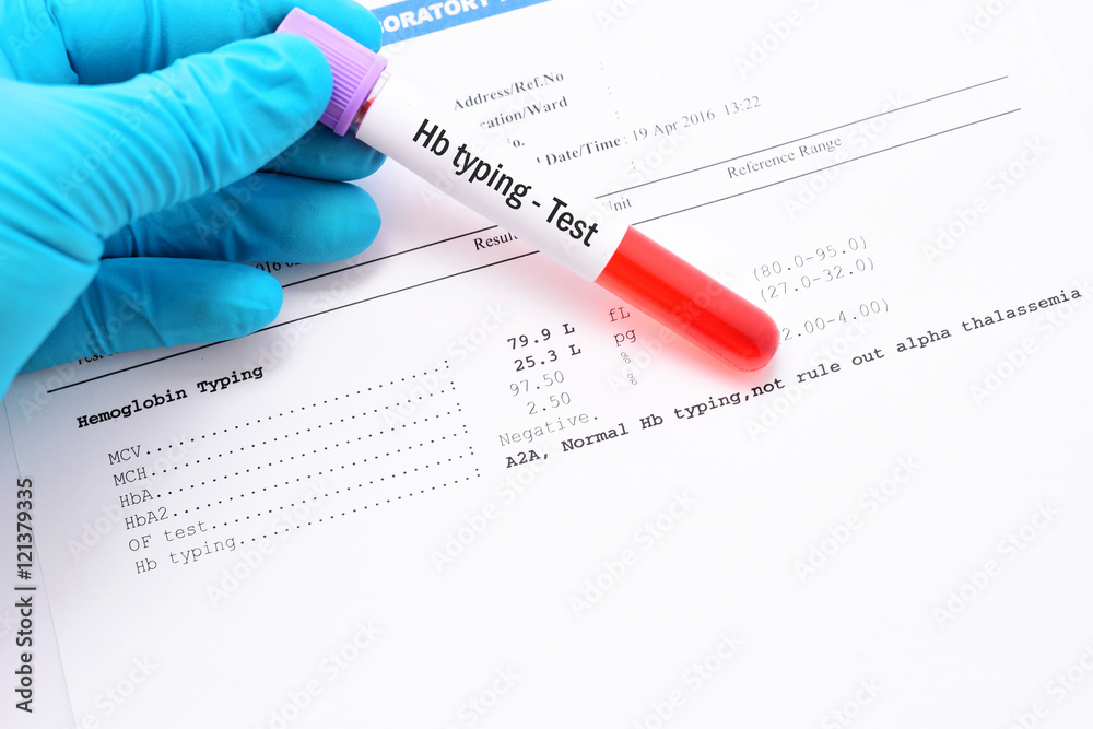 Blood sample for Hb typing test with normal result Stock Photo | Adobe ...