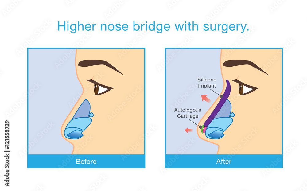 Before and after of woman face making nose bridge higher with surgery ...