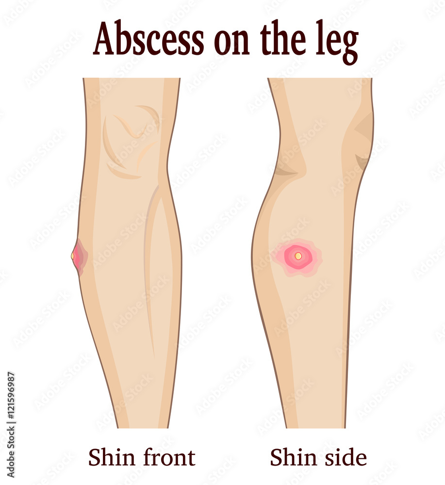 Image abscess on the leg from two perspectives Stock Vector | Adobe Stock