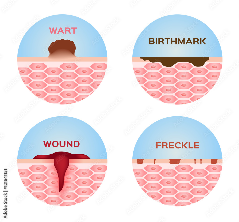 wart , wound , freckle and birthmark skin icon , logo and vector ...