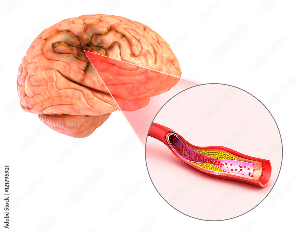 Brain stroke : 3d illustration of the vessels of the brain and causes ...