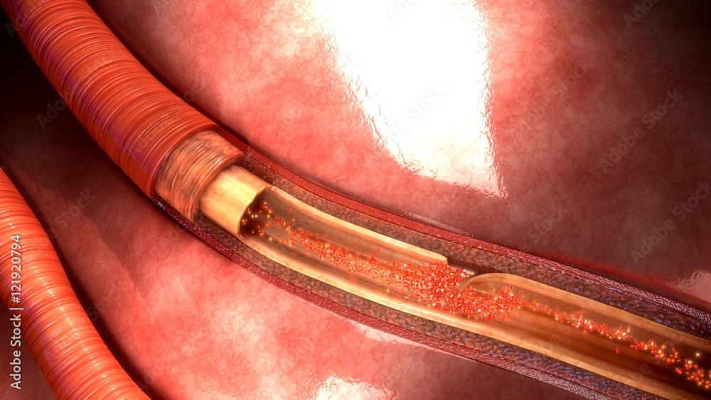 Poster Artery Dissection – Wall Art | UkPosters