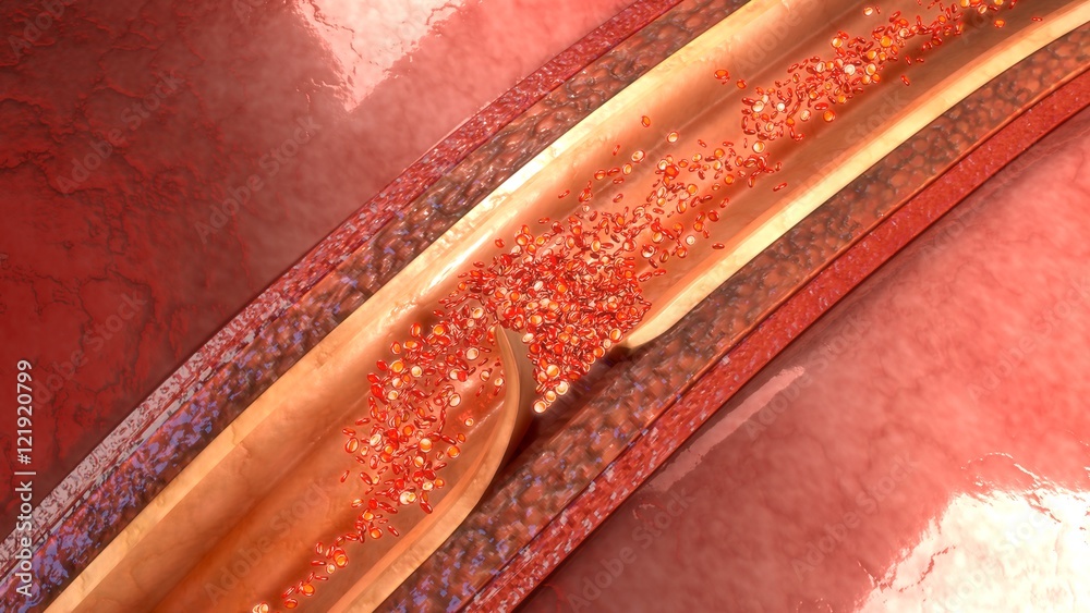 Artery Dissection Stock Illustration | Adobe Stock