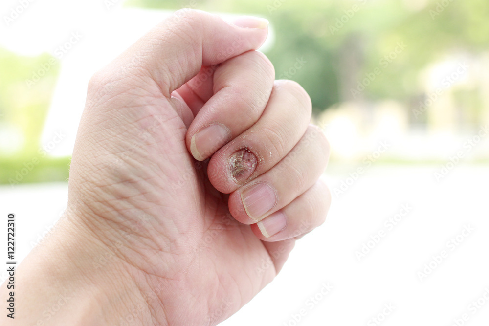 Fungal nail infection and damage on human hand. Finger with ...