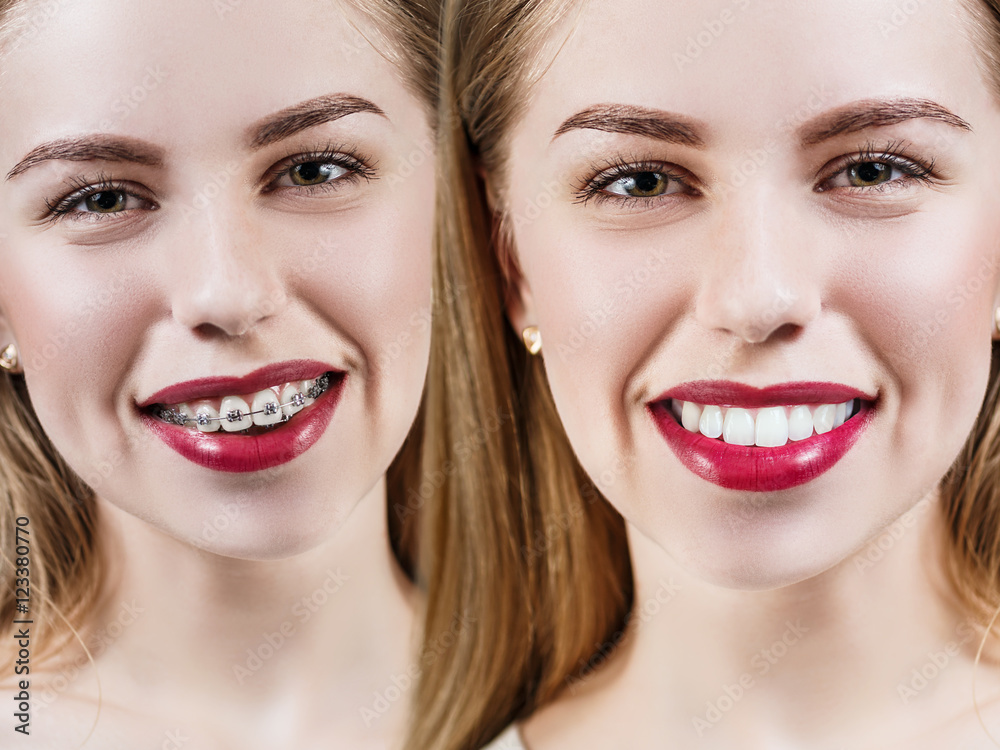 Perfect teeth before and after braces Stock Photo | Adobe Stock