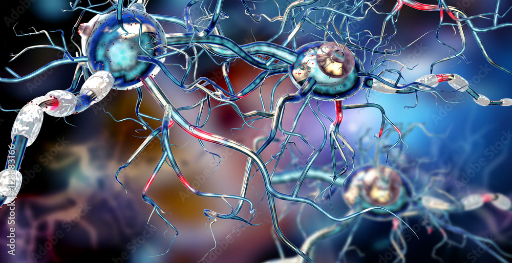 Damaged nerve cells, concept for neurodegenerative and neurological ...