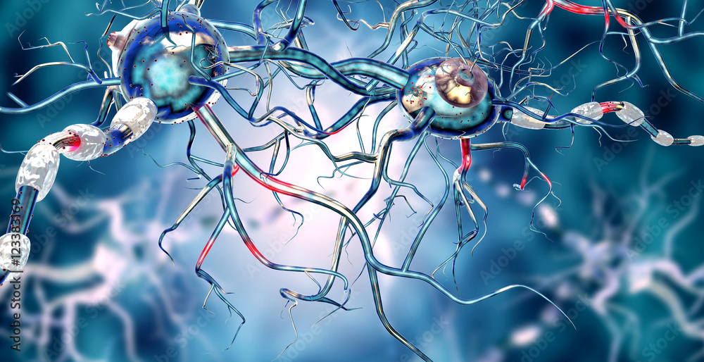 Damaged nerve cells, concept for neurodegenerative and neurological ...