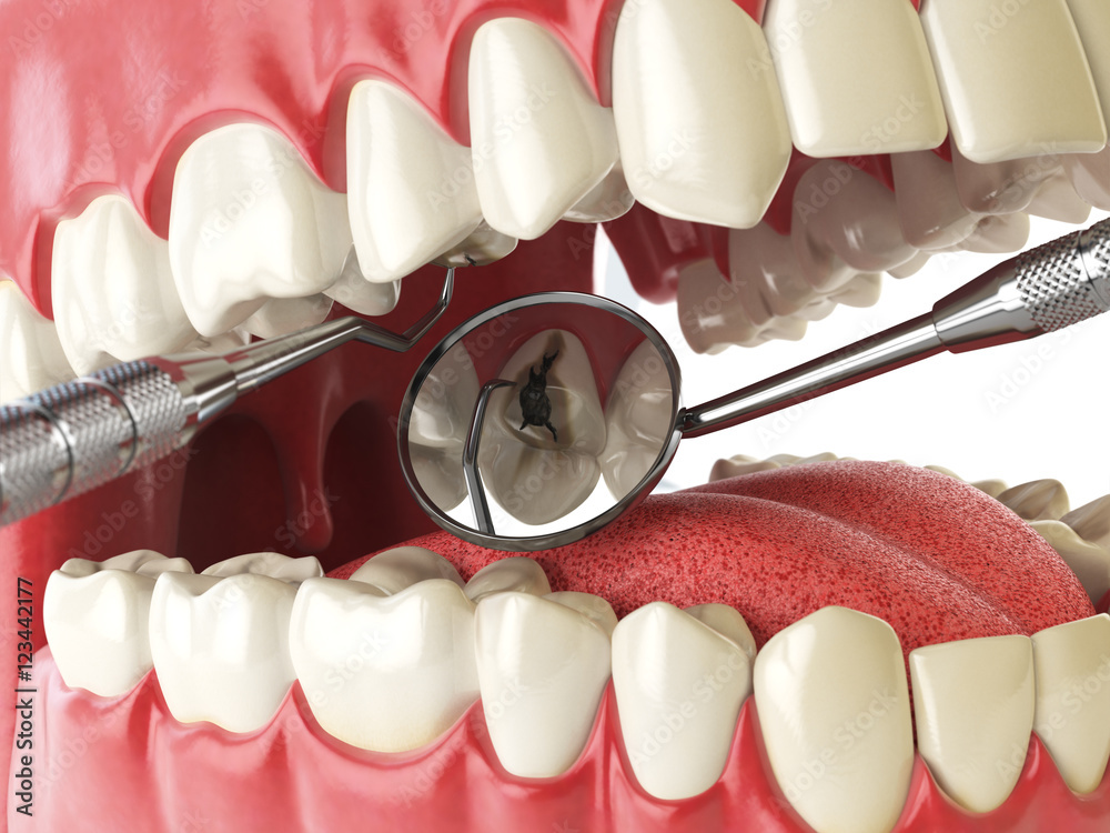 Human tooth with cariesand hole and tools. Dental searching conc Stock ...