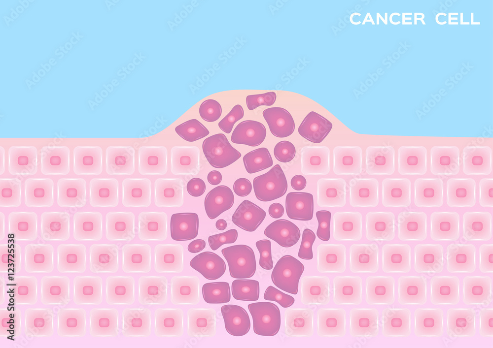 Photo & Art Print Cancer cell in a growing tumor vector , pink cancer ...