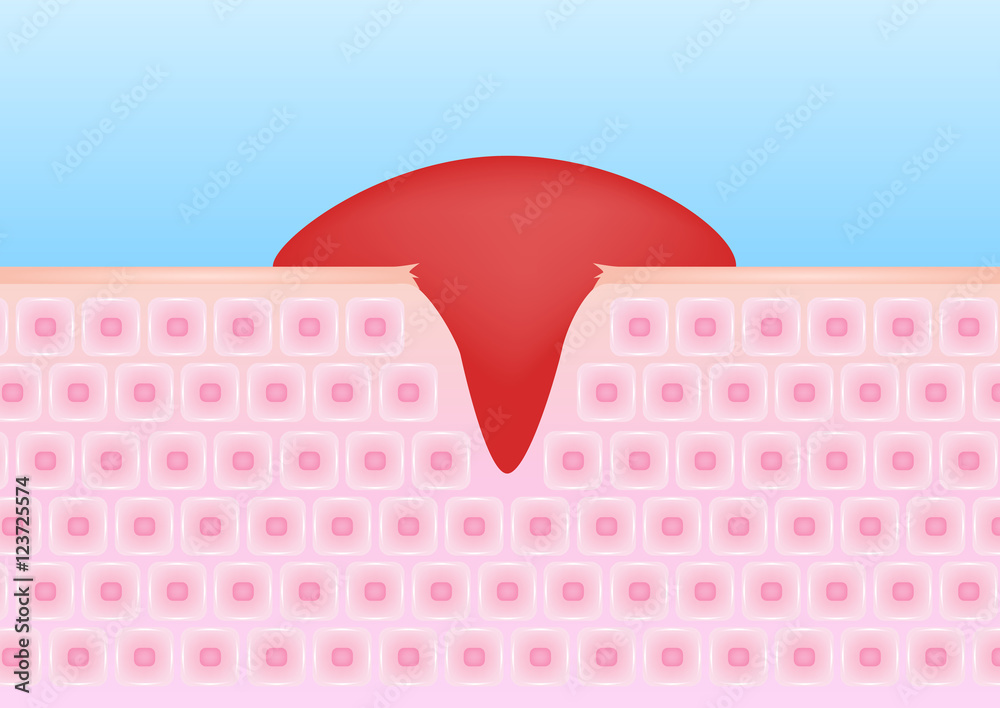 wound skin vector graphic . the blood come out of wound , bleeding ...