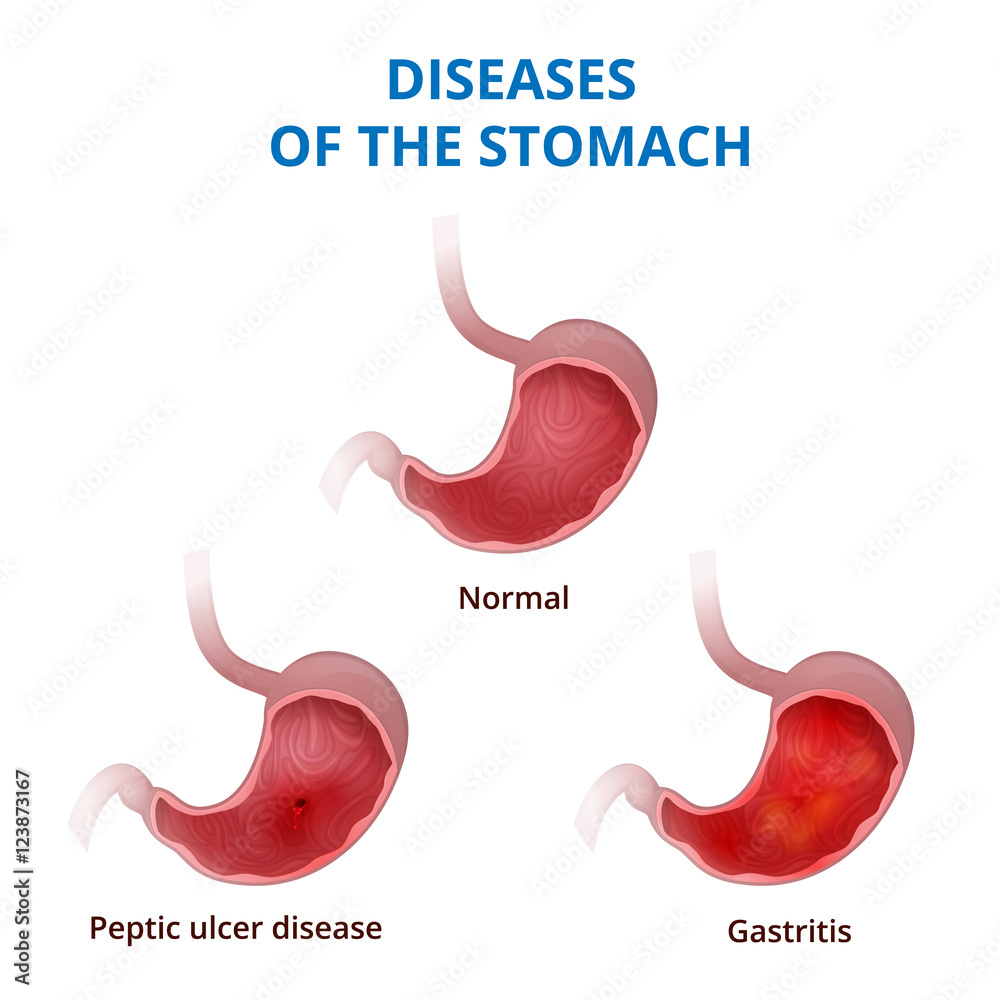 Anatomy of the human healthy and unhealthy stomach Stock 벡터 | Adobe Stock
