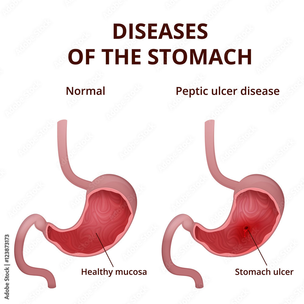 Anatomy of the human healthy and unhealthy stomach Stock Vector | Adobe ...