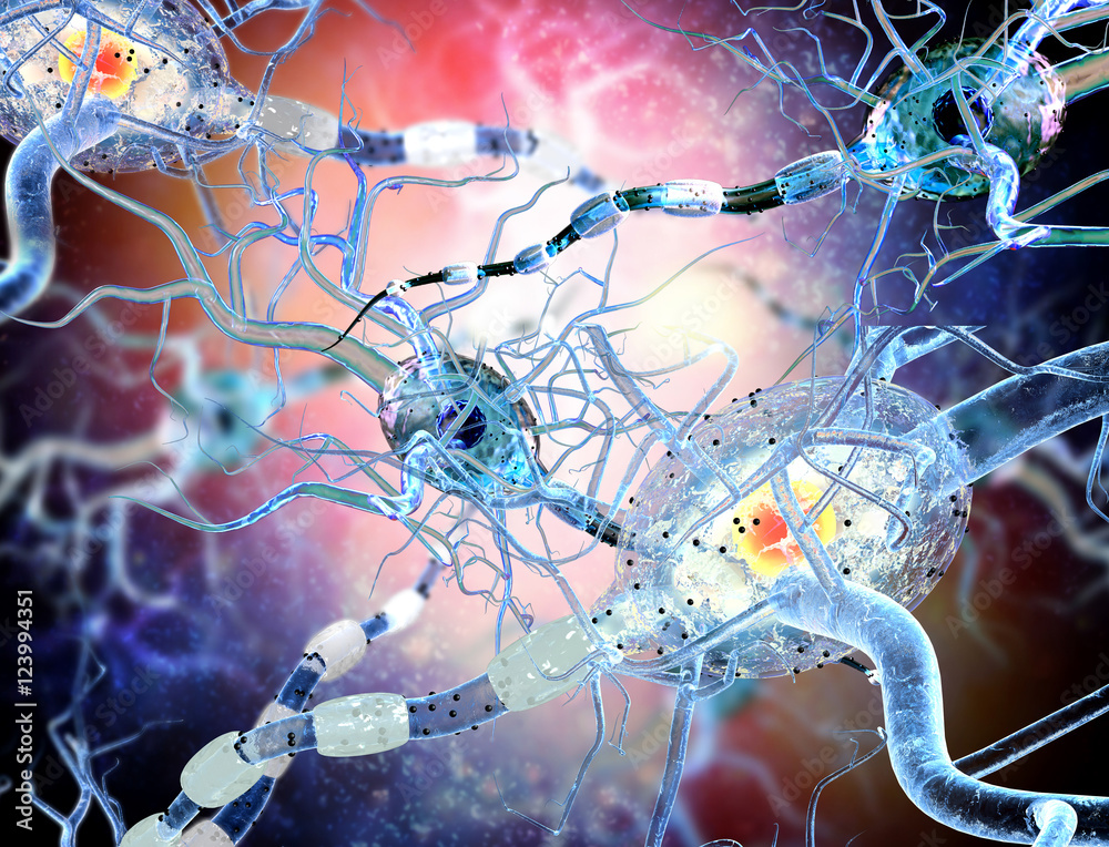 Damaged nerve cells, concept for neurodegenerative and neurological ...