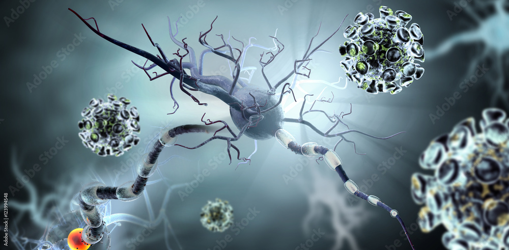 Damaged nerve cells, concept for neurodegenerative and neurological ...