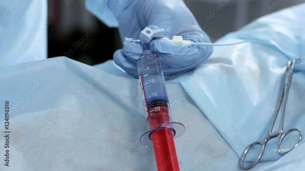 Embolic material in syringe, pva embolization particles Stock Video ...