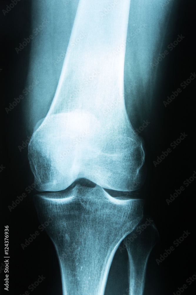 Knie Knochen Röntgenbild Stock Photo | Adobe Stock