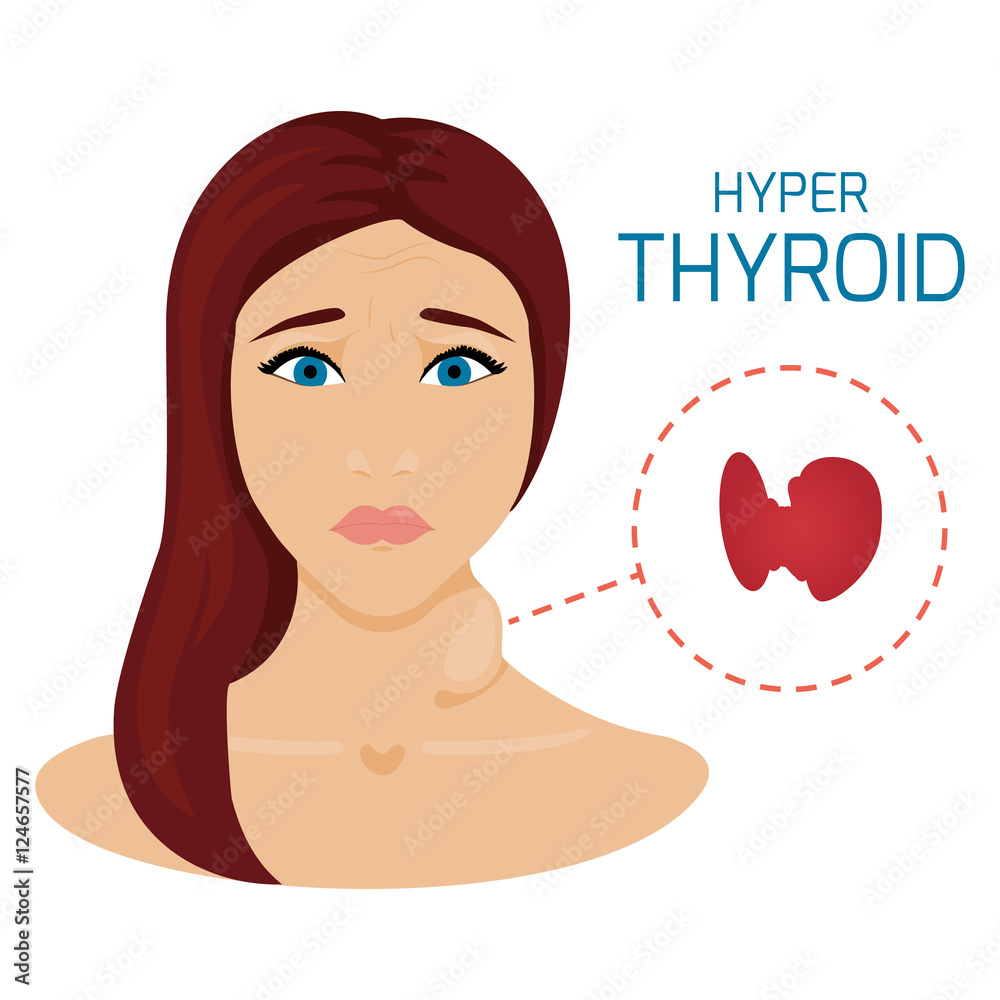 Woman with hyperthyroid gland. Hyperthyroidism symbol. Enlarged thyroid ...