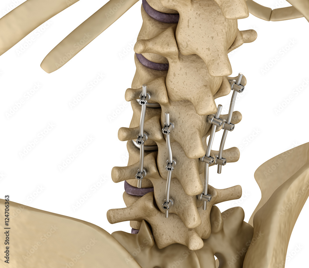 Spinal fixation system - titanium bracket. Medically accurate tooth 3D ...