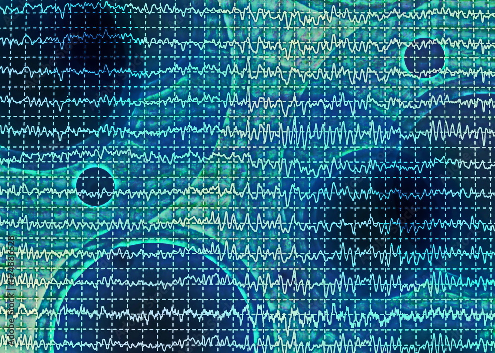Brain wave on electroencephalogram EEG for epilepsy Stock Illustration ...