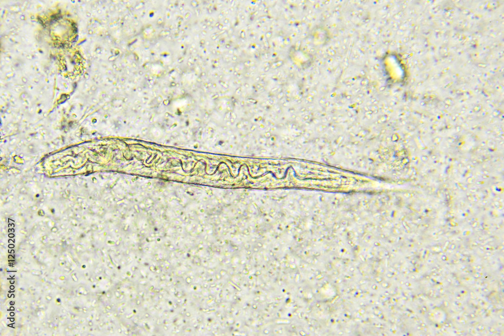 Strongyloides stercoralis (threadworm) in stool, analyze by microscope ...