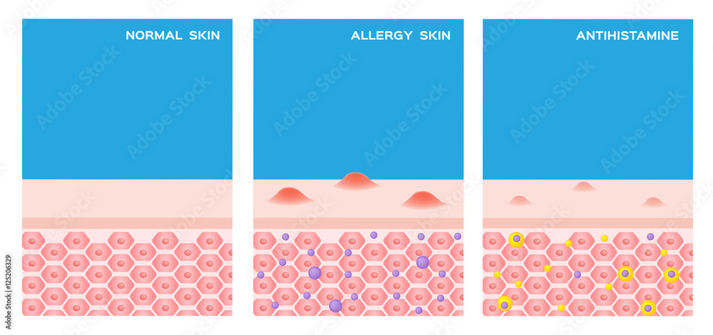 allergy skin vector . step of allergy skin before and after taking a ...