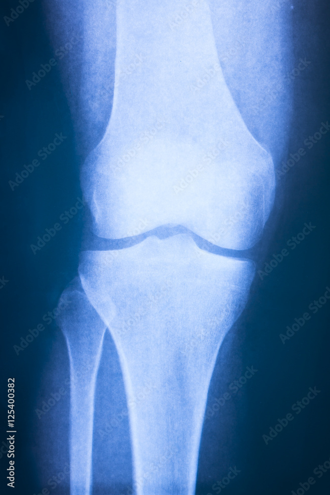 Knee x-ray. X-ray health care image. Stock Photo | Adobe Stock