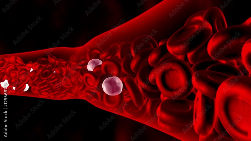 Red blood cells. Clogged Artery. Digital Animation, medical concept ...