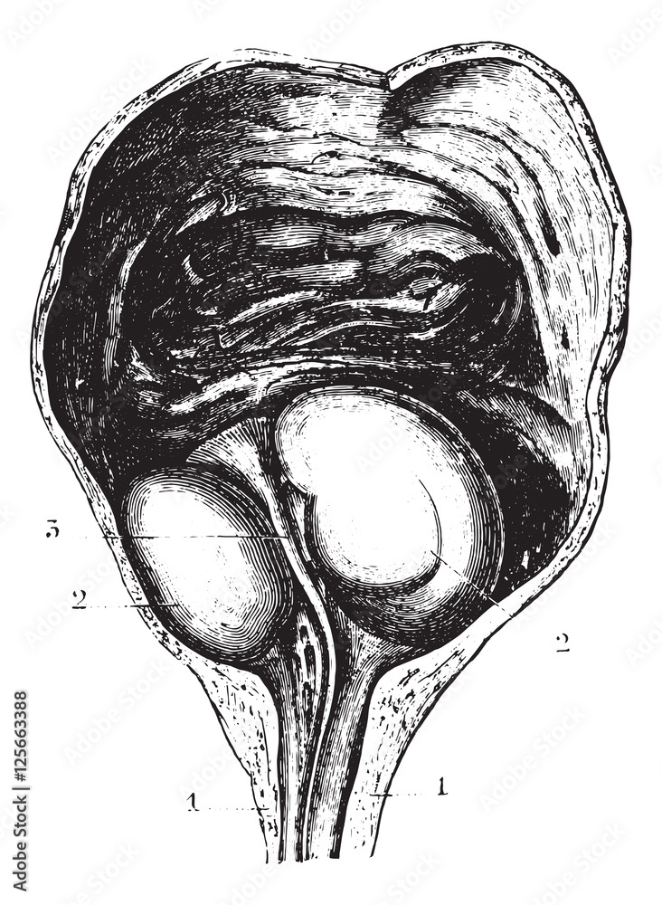 Enlarged prostate or Benign prostatic hyperplasia (BPH), determi Stock ...