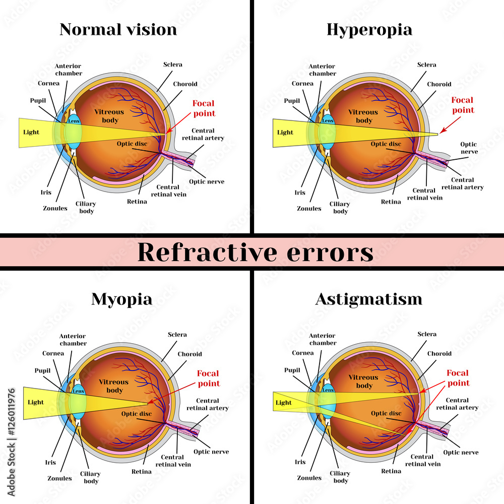 Myopia Hyperopia Astigmatism