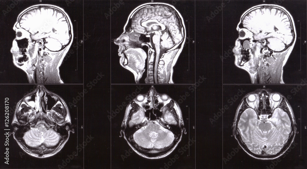 Magnetic resonance image (MRI) of the human brain Stock Photo | Adobe Stock