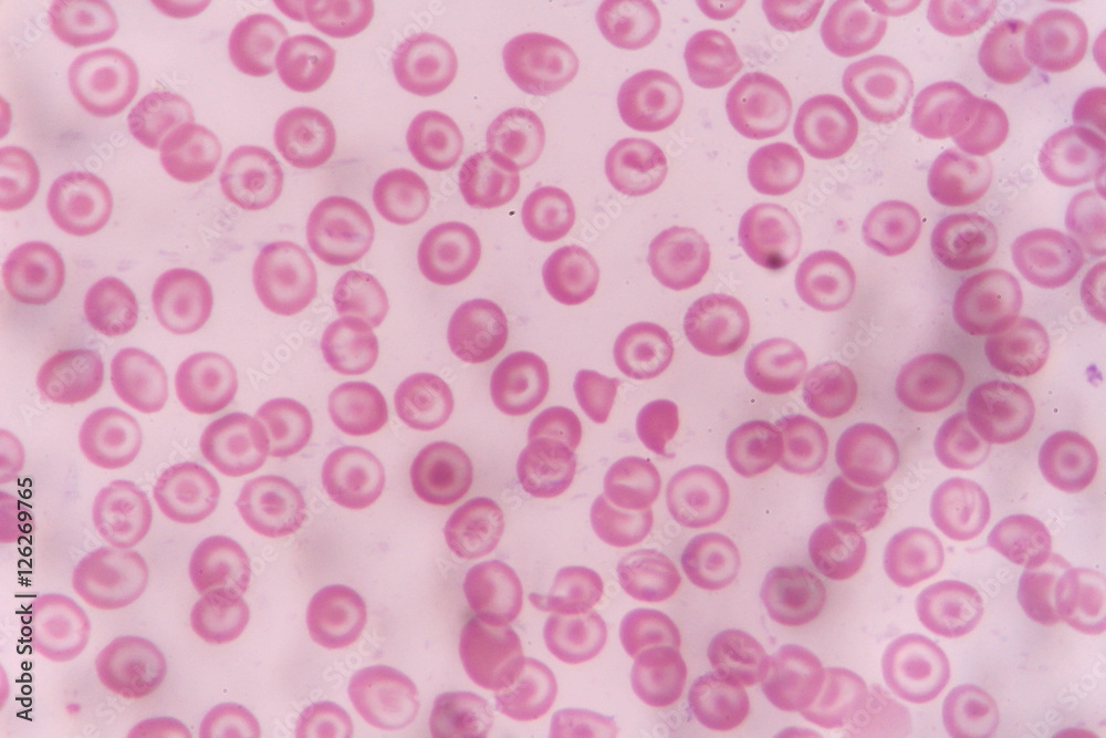 in Slide blood smear show target cell for complete blood count in ...