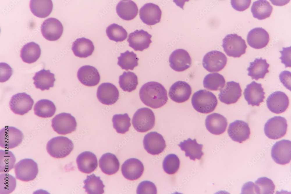 plasmodium malariae ring form state in fection of red blood cells Stock ...