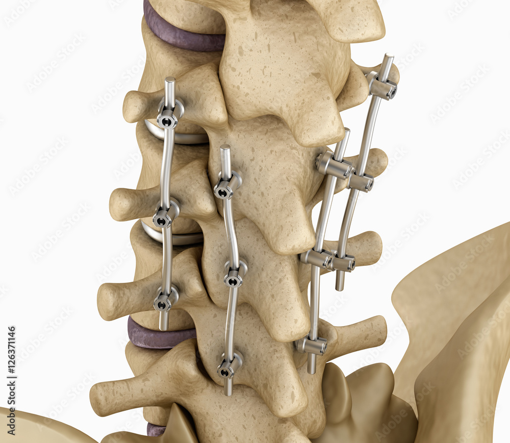 Poster Spinal fixation system - titanium bracket – Wall Art | UkPosters