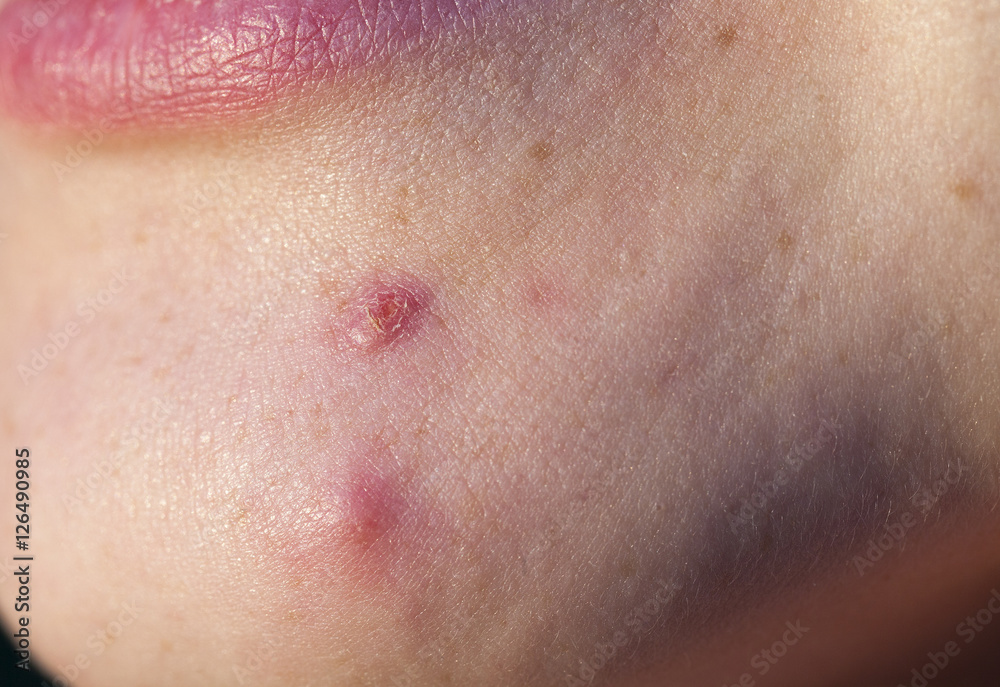pimple on the chin Stock Photo | Adobe Stock