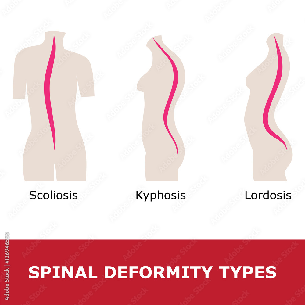 scoliosis, lordosis and kyphosis. vector illustration of spinal ...