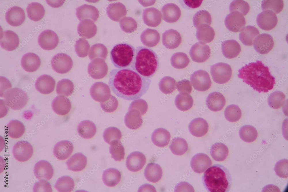 Blood smear shows large number of cancer leukemia cells(Blast cells ...