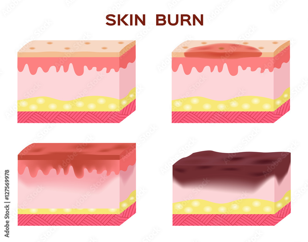 step of skin burn . Normal skin to serious burn skin . vector and icon ...