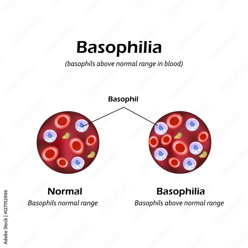 Basophils above the normal range in the blood. Basophilia. Infographics ...