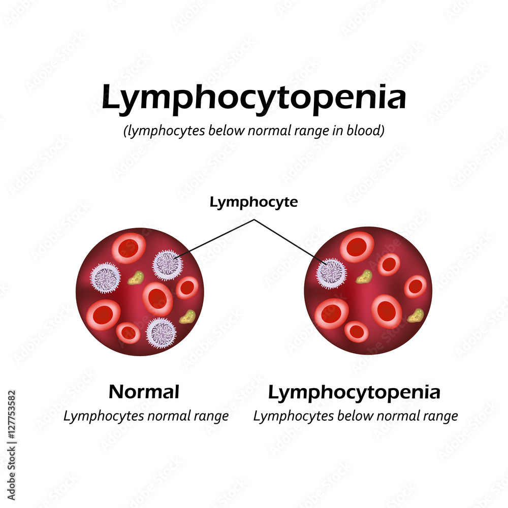 Lymphocytes below the normal range in the blood. Lymphocytopenia ...