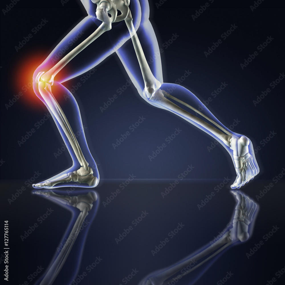 X-ray Runner with Knee Pain ilustração do Stock | Adobe Stock