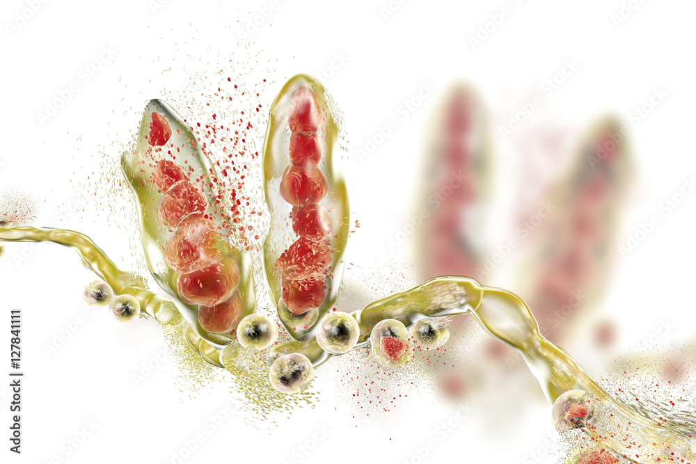 Destruction of fungus Trichophyton mentagrophytes which causes athlete ...