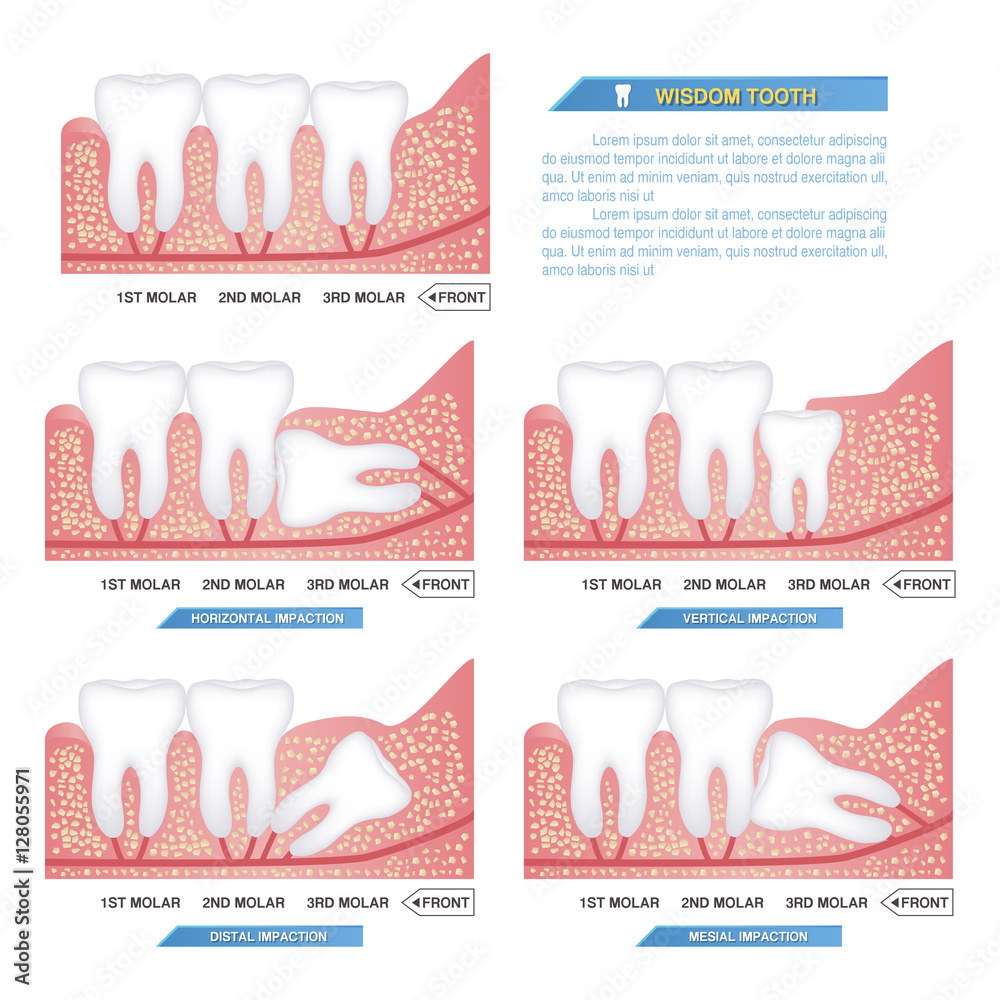 set of impacted wisdom tooth, dental problems, horizontal, mesial ...
