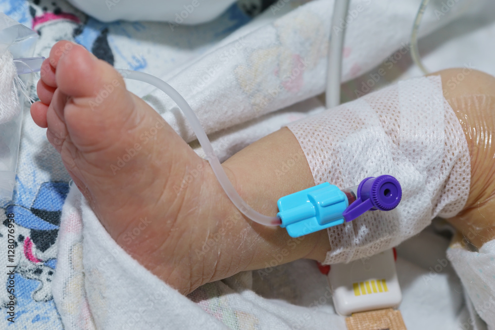 Peripheral intravenous catheter in the vein of newborn baby foot Stock ...