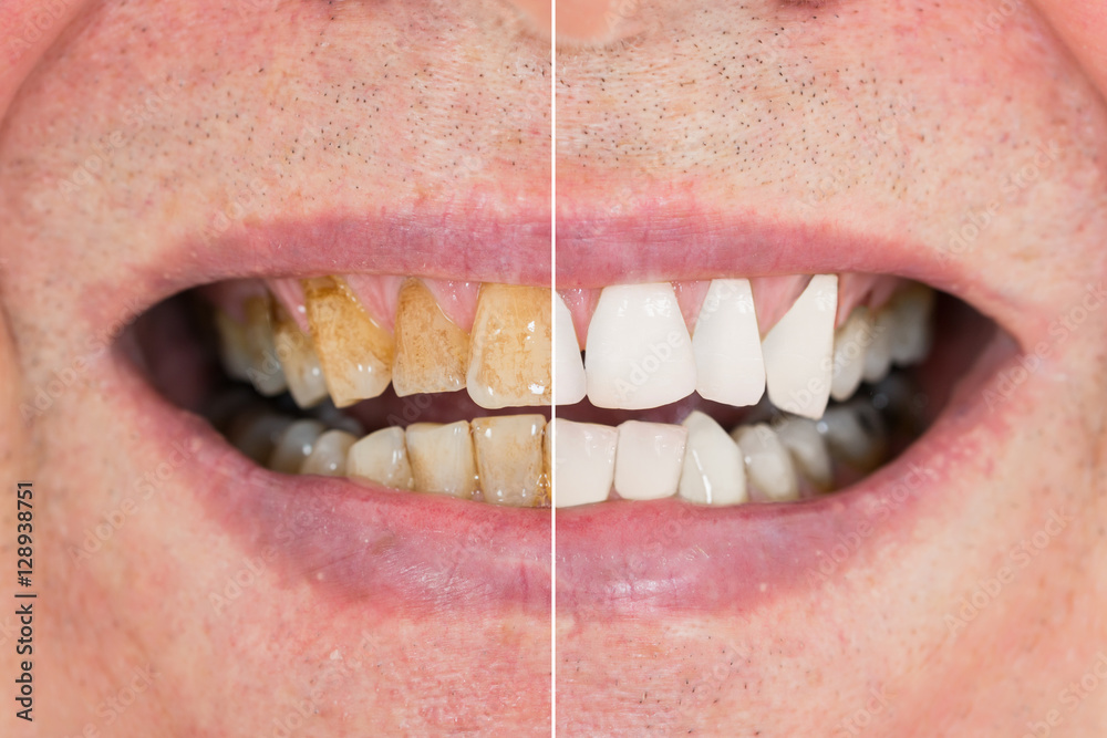 Man Teeth Before And After Whitening Stock Photo | Adobe Stock