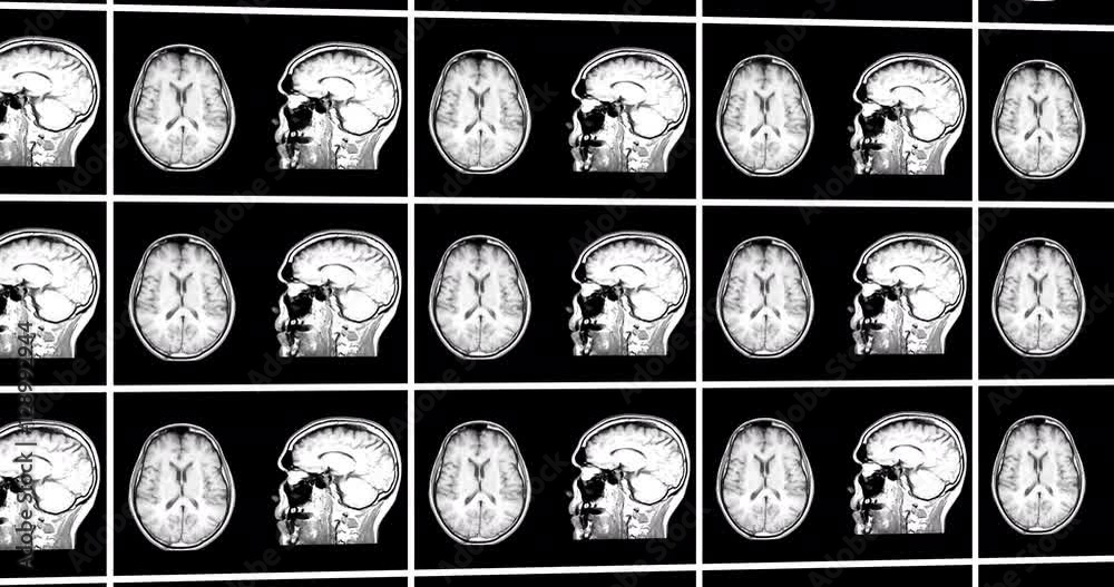 Brain top and lateral cut MRT scan. Diagnostic Medical Tool Monitor 2D ...