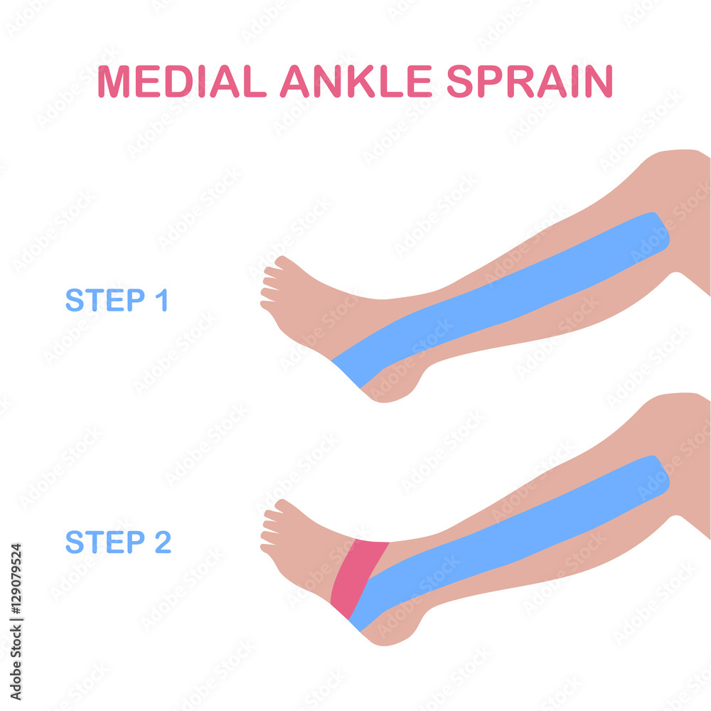 Poster Medial ankle sprain – Wall Art | UkPosters