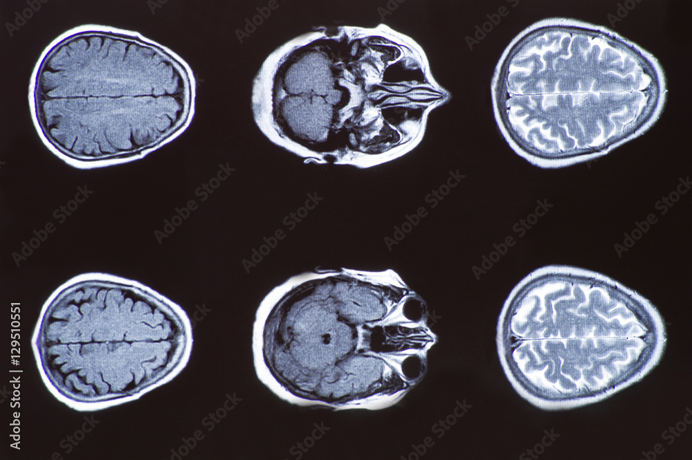 X-ray image of the brain computed tomography Stock Photo | Adobe Stock